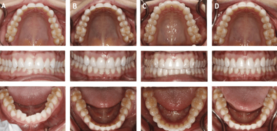 How to increase predictability for faster tooth movement | Propel ...