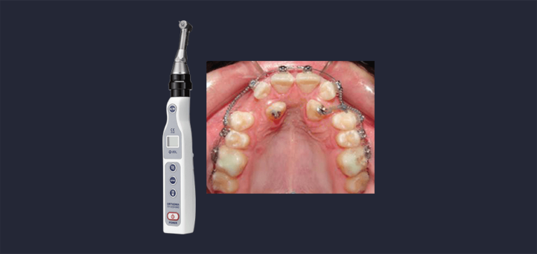 Impacted Canines (6 Months) | Propel Orthodontics