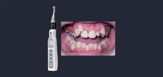 Anterior Crossbite (3 Months) | Propel Orthodontics