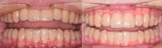 Lower Anterior Relapse (4 Months) | Propel Orthodontics