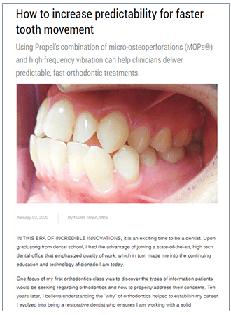 How to increase predictability for faster tooth movement | Propel ...