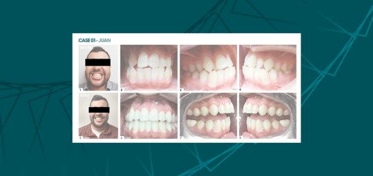 How to increase predictability for faster tooth movement | Propel ...